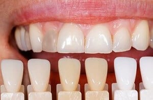 Internes Bleaching Für & Wider - Weiße Zähne mit Bleaching